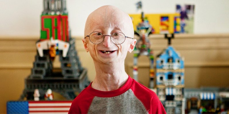 ¿Sabes qué es la progeria? - Periodista Digital